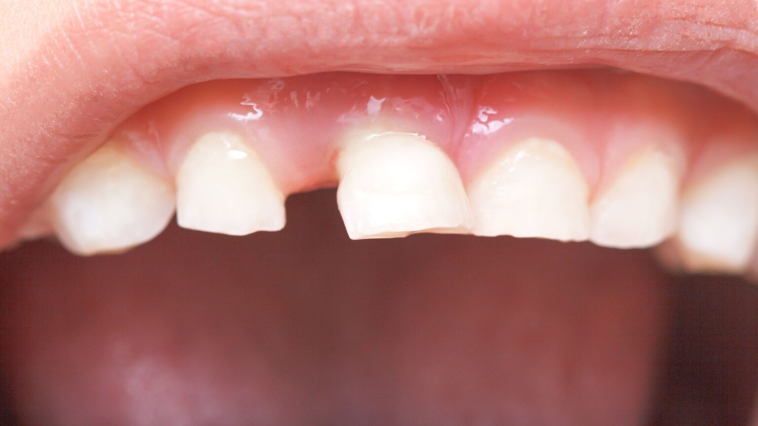 La agenesia dental | Asistencia Dental Especializada